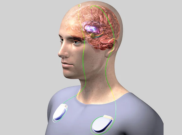 Deep Brain Stimulation (DBS)